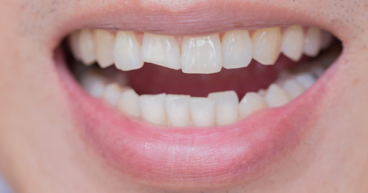 Gebroken tand: de verschillende situaties en oplossingen… | GlamSmile