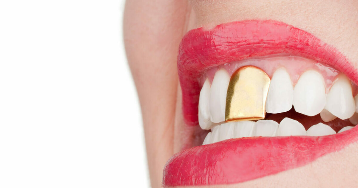Een gouden tand: nog van deze tijd? | GlamSmile